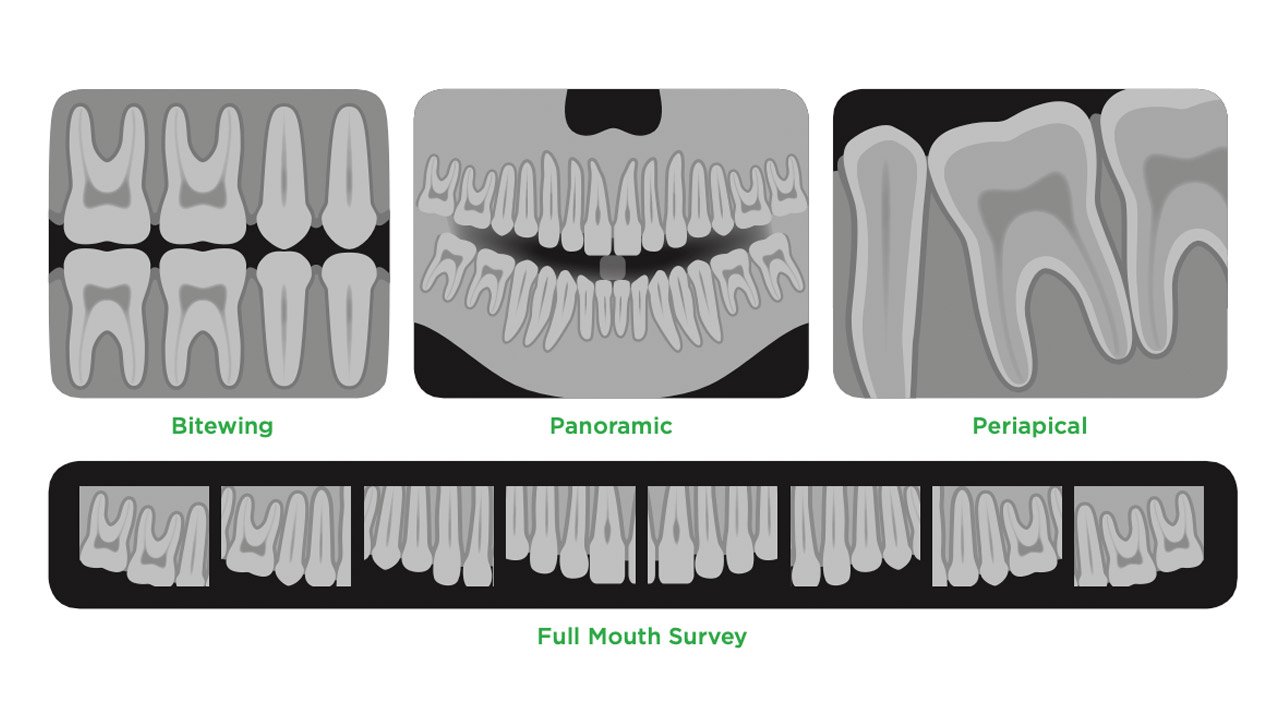 Dental Procedures Decoded: X-Rays | Dental Worksheet - Healthy Smile ...